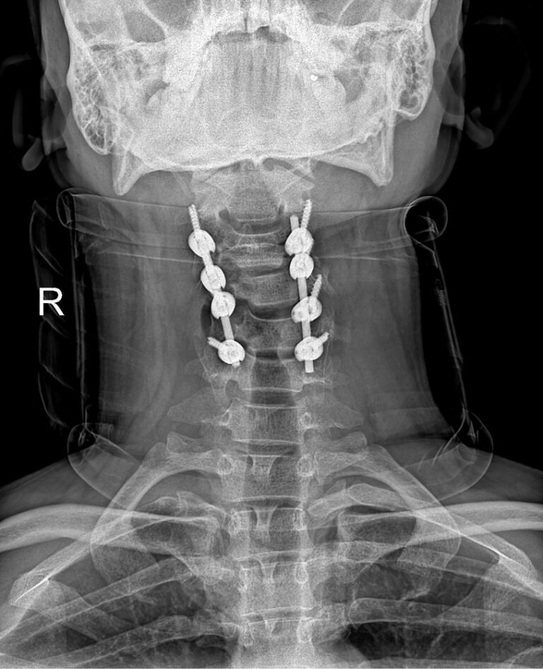 C2 Fractures/Hangman's Fracture After a Car Accident in San Diego